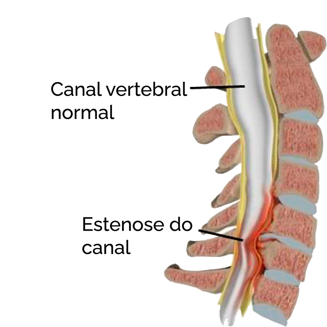 3 patologias que a Cirurgia Artrodese trata - Dr Jânio Alves Ferreira